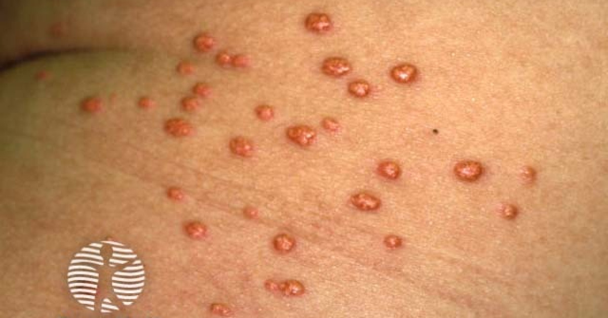 Eruptive xanthoma image