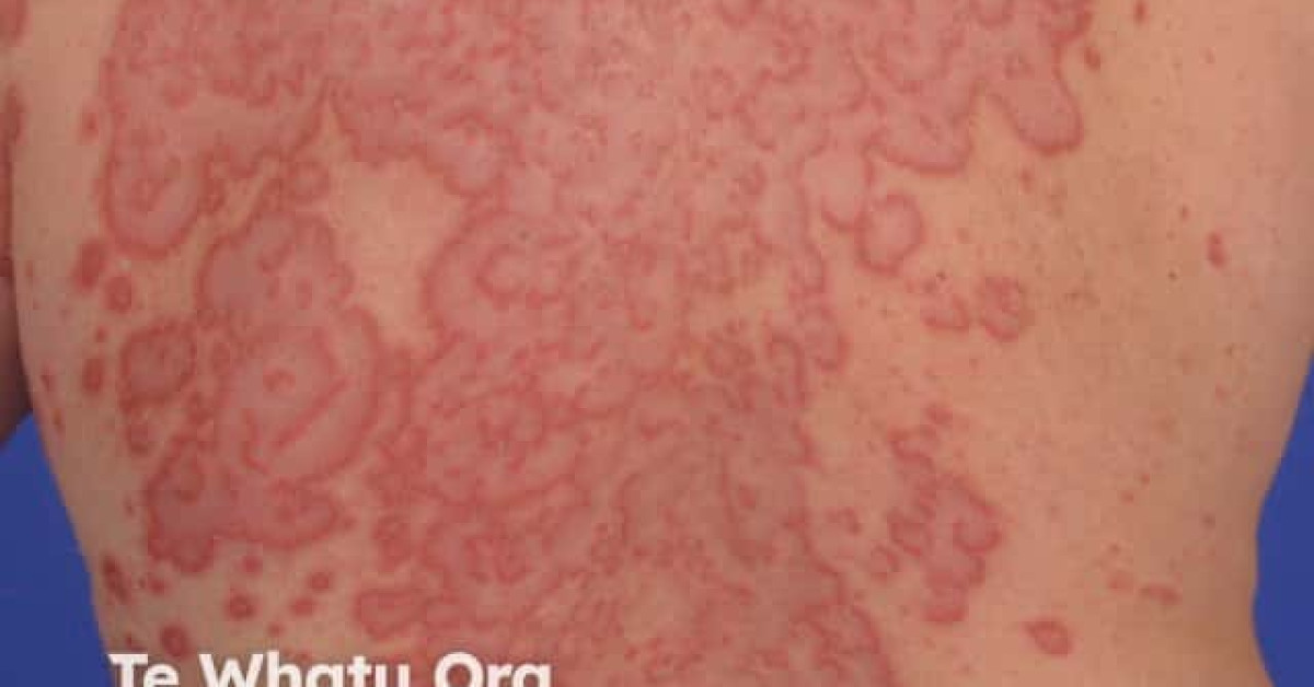Erythema Gyratum Repens