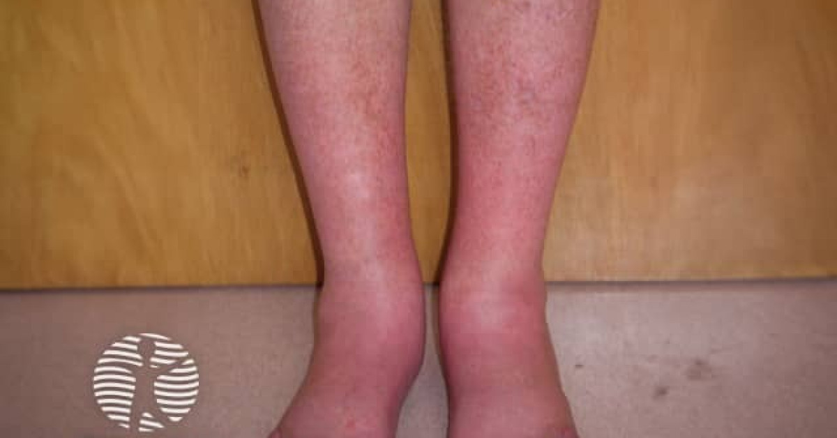 Erythromelalgia image