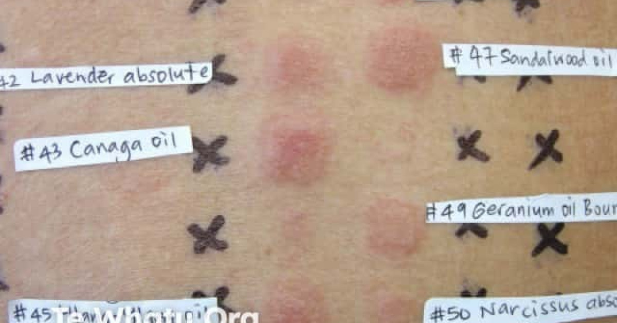 Positive patch tests to essential oils image