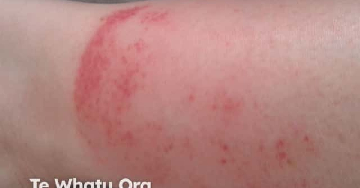 Exercise Induced Capillaritis