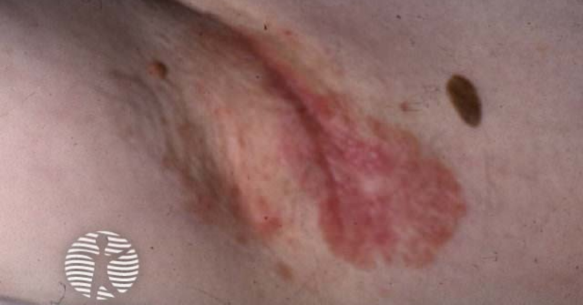 Extramammary Paget disease of the skin of the axilla image