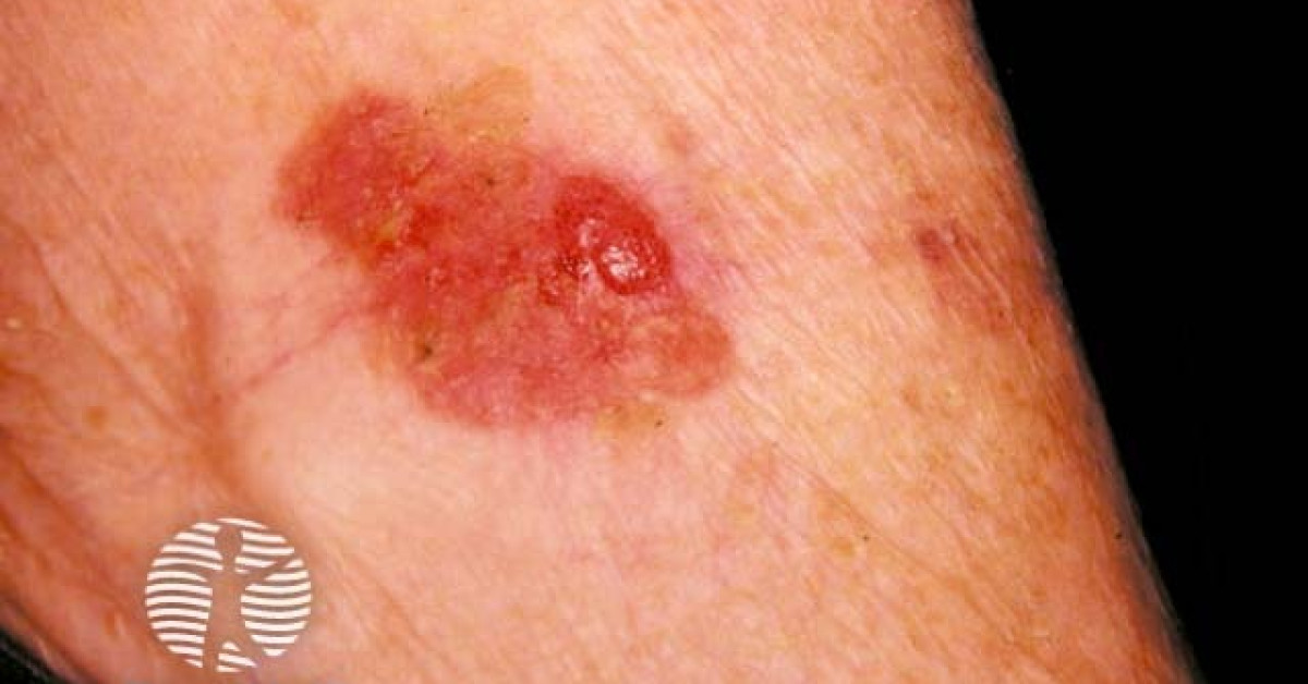 Extramammary Paget disease of the skin of the axilla image