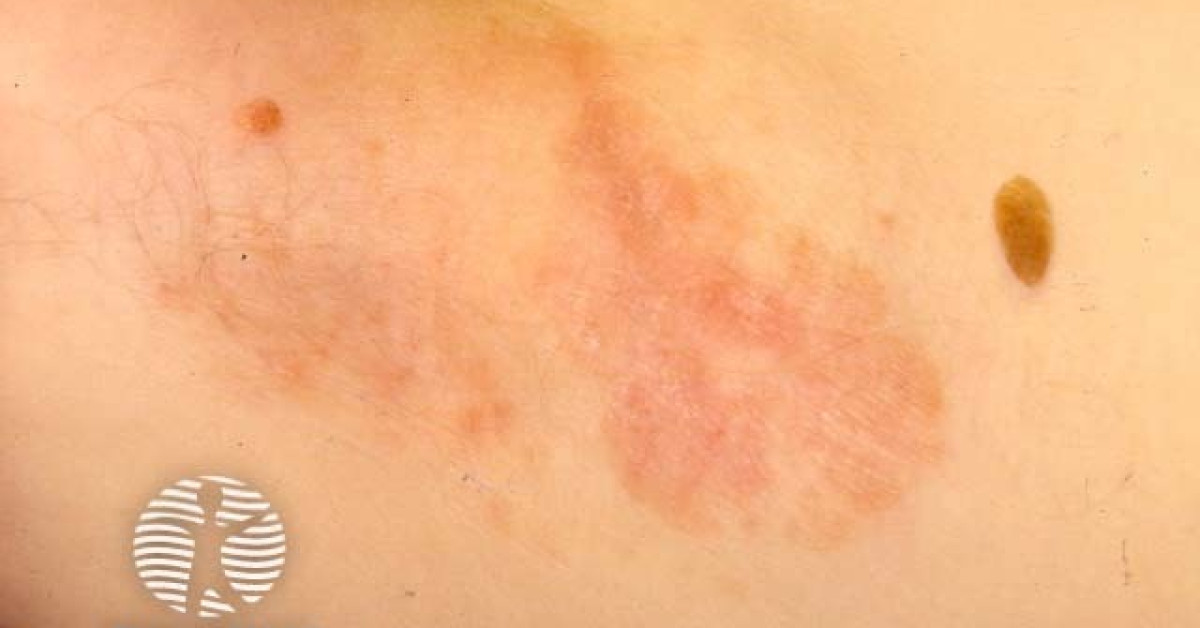 Extramammary Paget disease of the skin of the axilla image