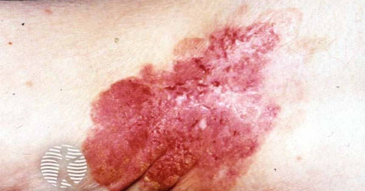 Extramammary Paget disease of the skin of the axilla image