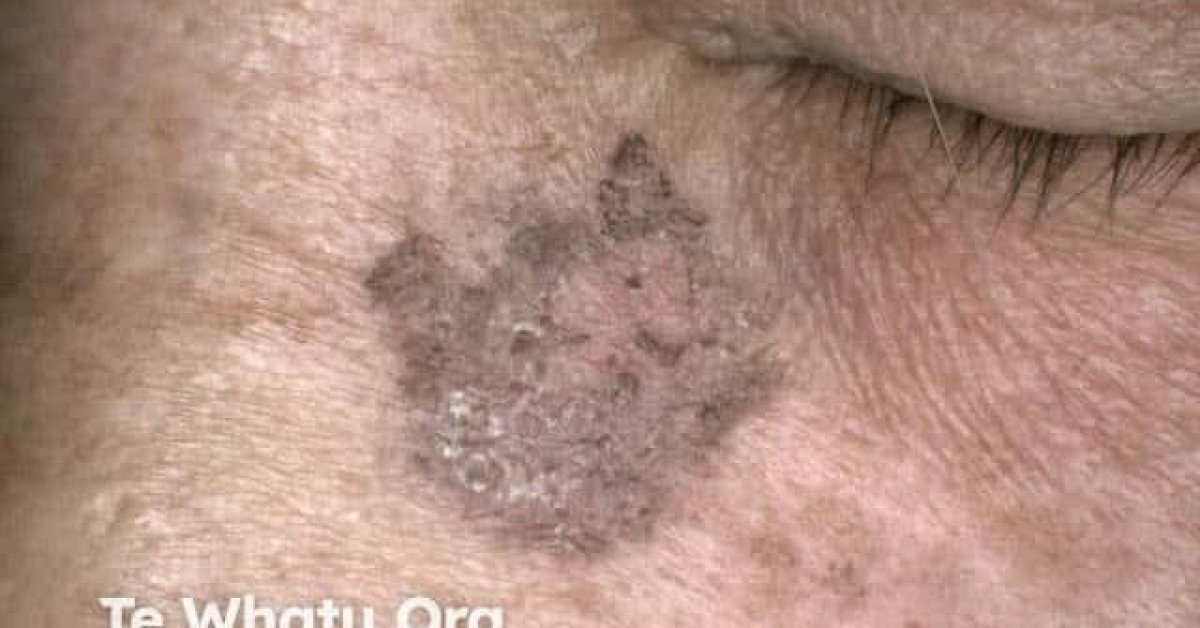 Pigmented actinic keratosis image
