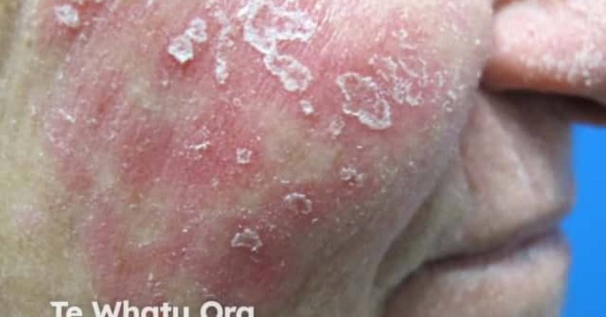 Facial psoriasis image