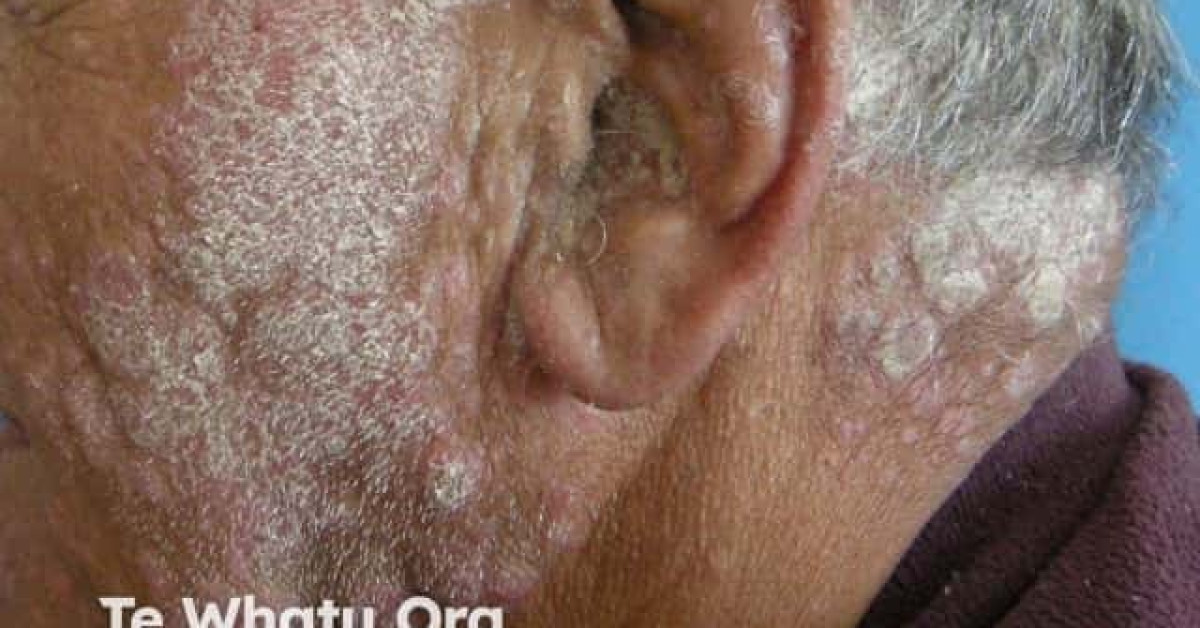 Facial psoriasis image