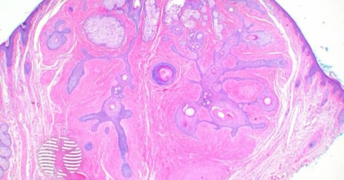 Folliculosebaceous cystic hamartoma histology image
