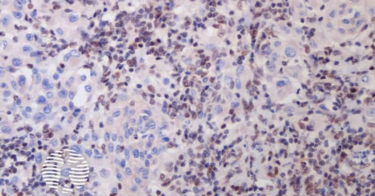 BAP-oma histology x20, IHC. Loss of BAP1 expression (brown staining) of ...