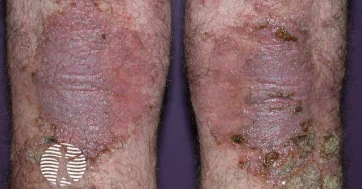 figure 1 itch2 image