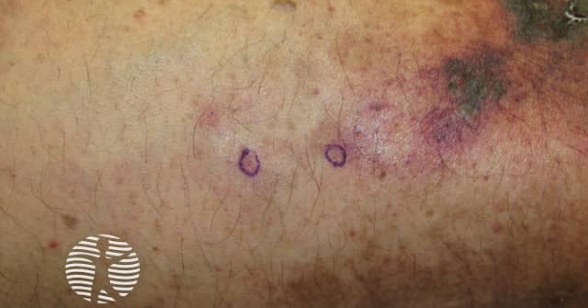 figure 13 fever+rash2 image