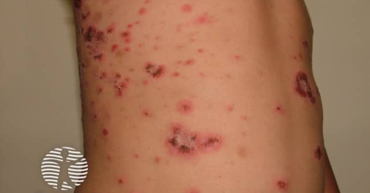 DermNet® - figure 136 trunk image