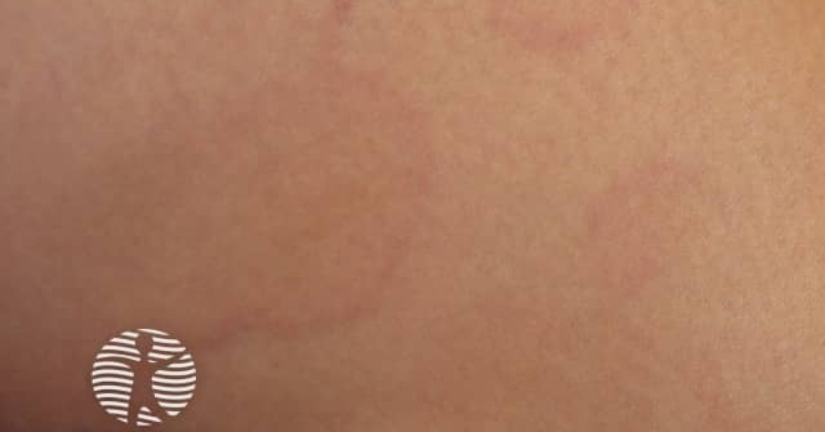 figure 18 fever+rash2 image