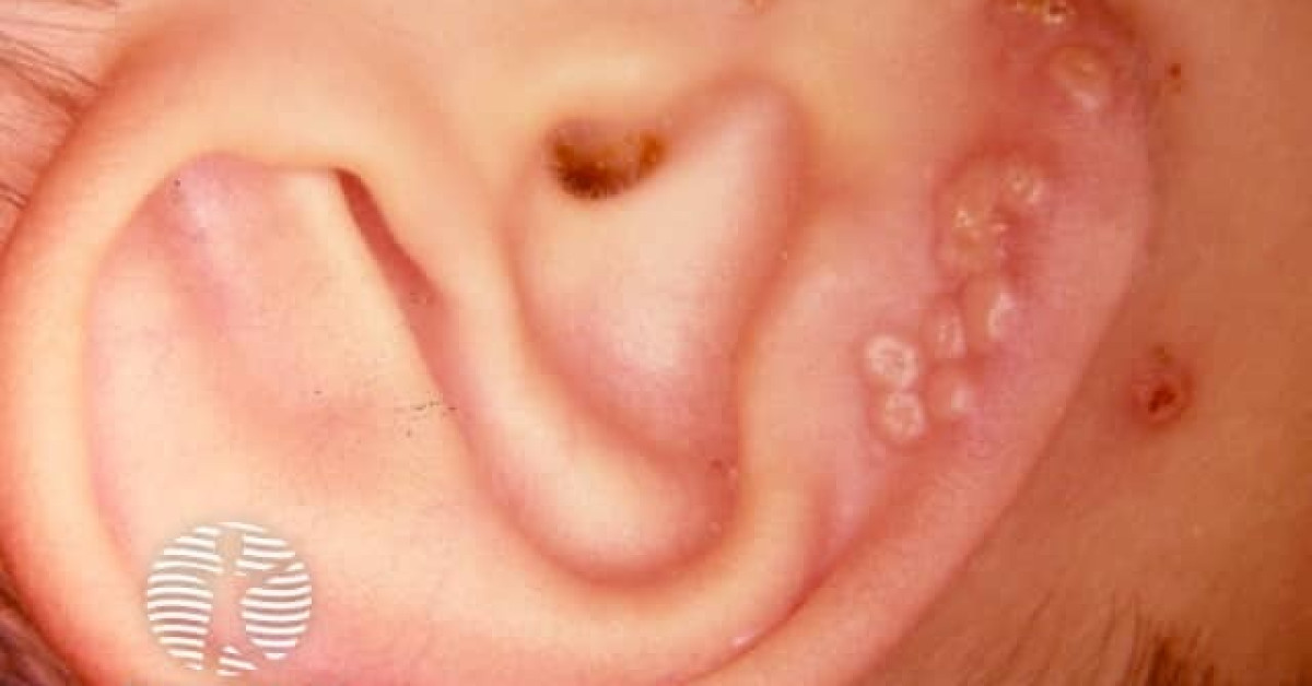 DermNet® - figure 21 blistering image