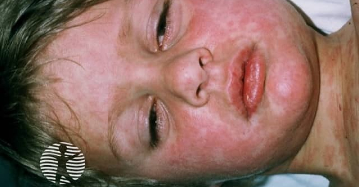 figure 21 fever+rash image