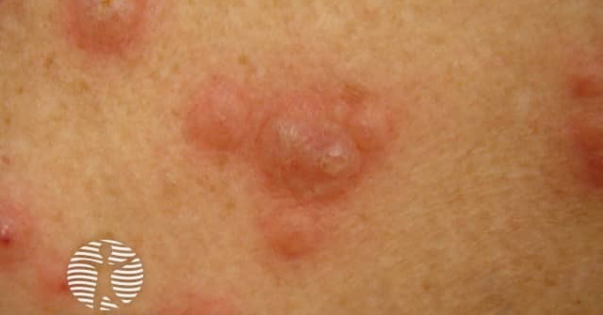 figure 24 fever+rash2 image