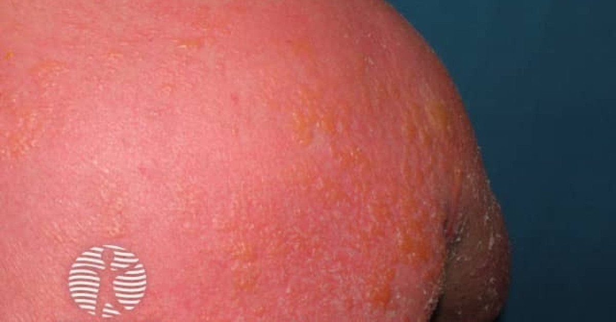 DermNet® - figure 26 blistering image