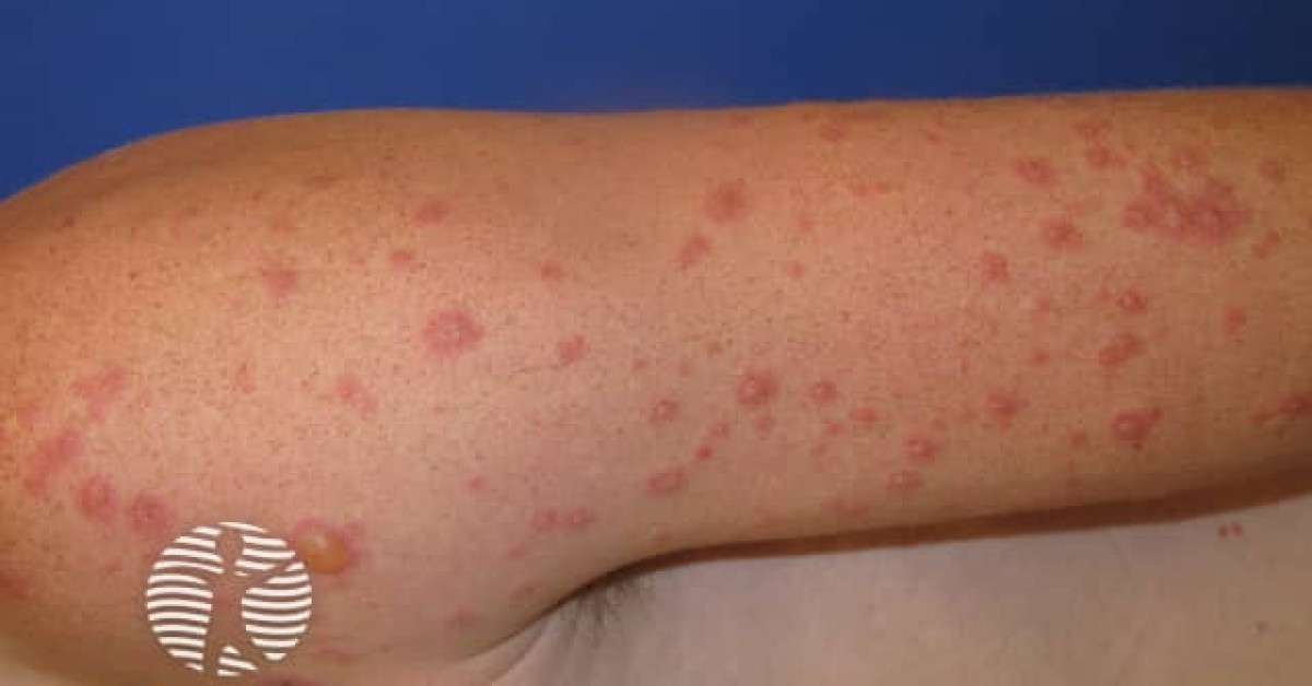 Figure 26 Fever rash2 Image