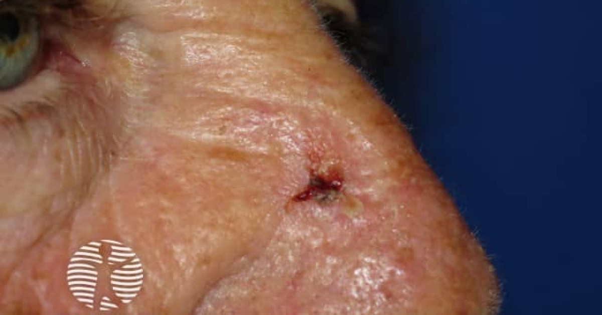 Basal cell carcinoma image