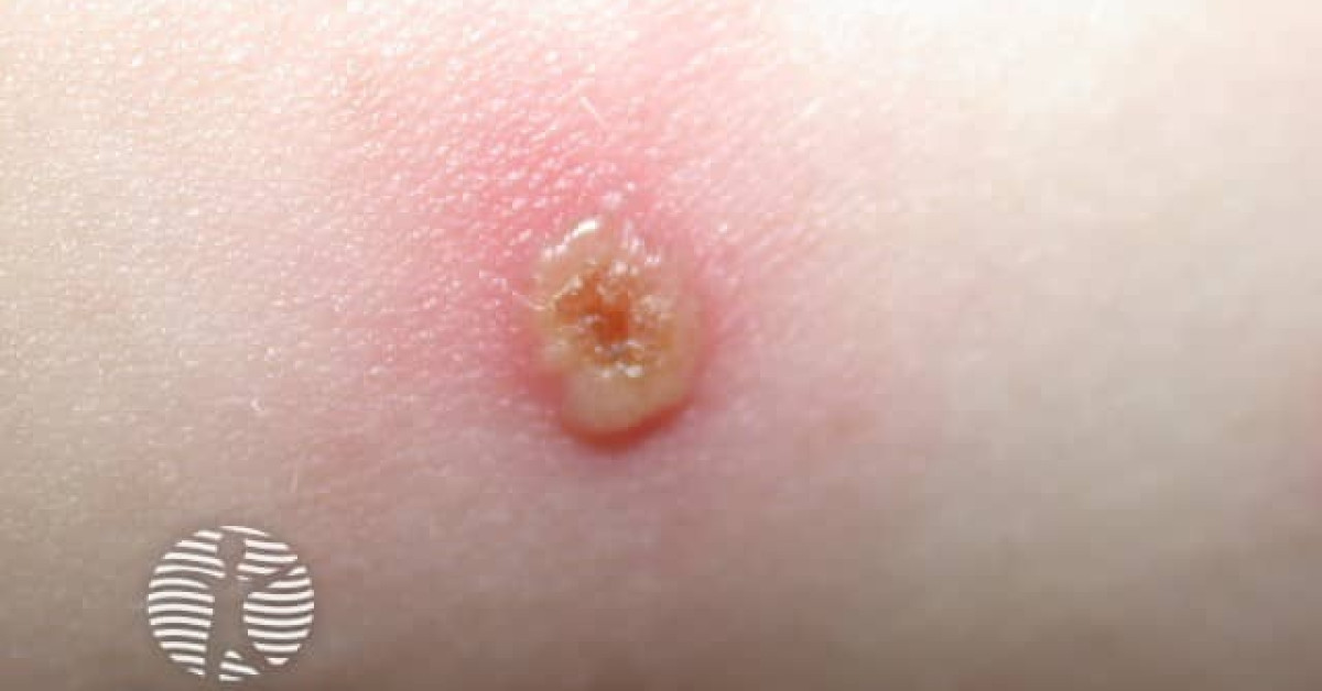 figure 31 fever+rash image