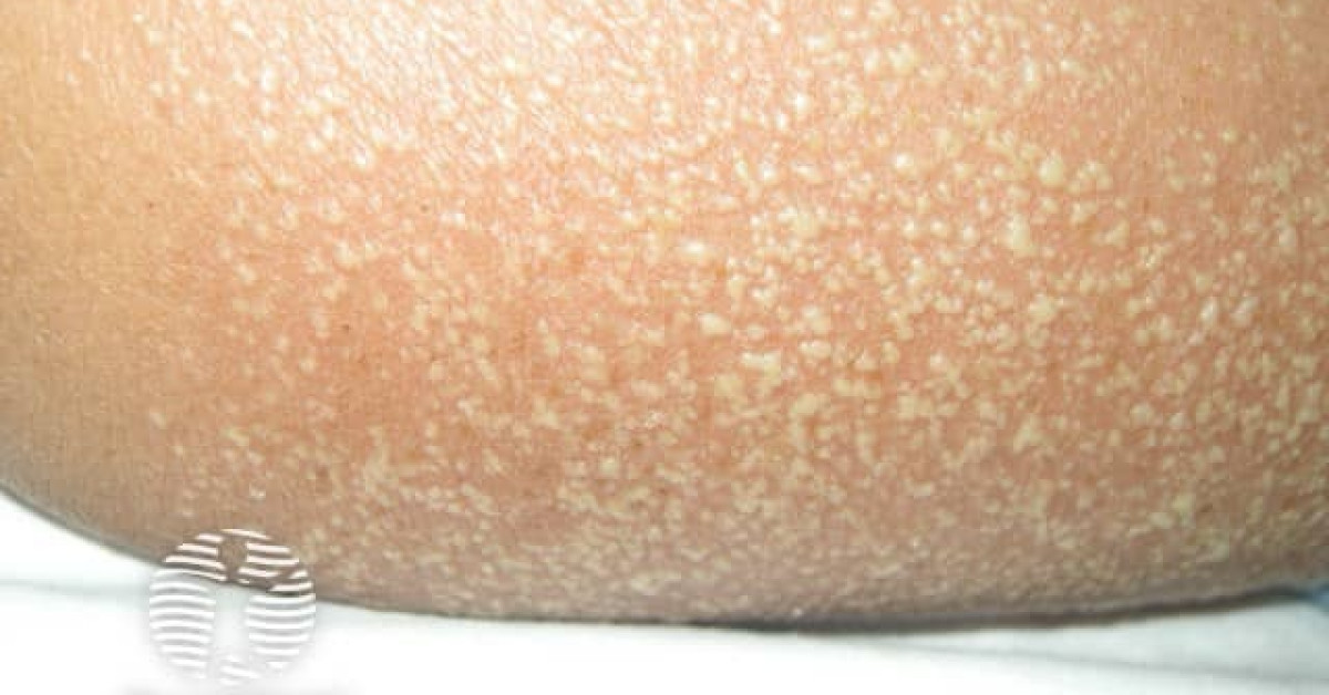 figure 32 fever+rash2 image