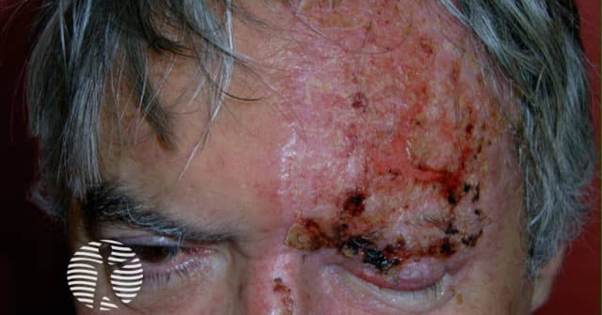 Herpes zoster image