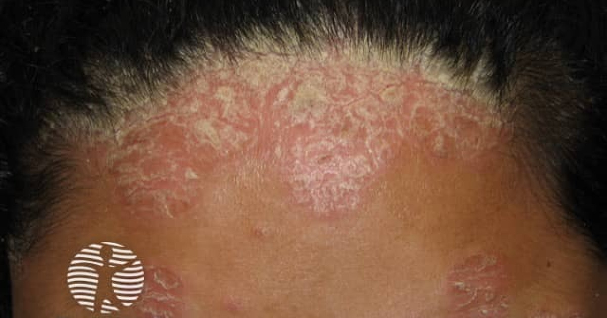 Psoriasis image