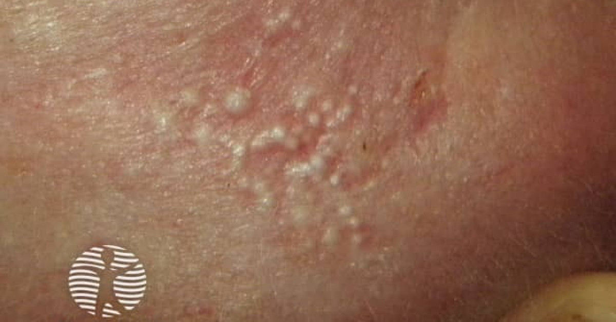 Closed comedones image