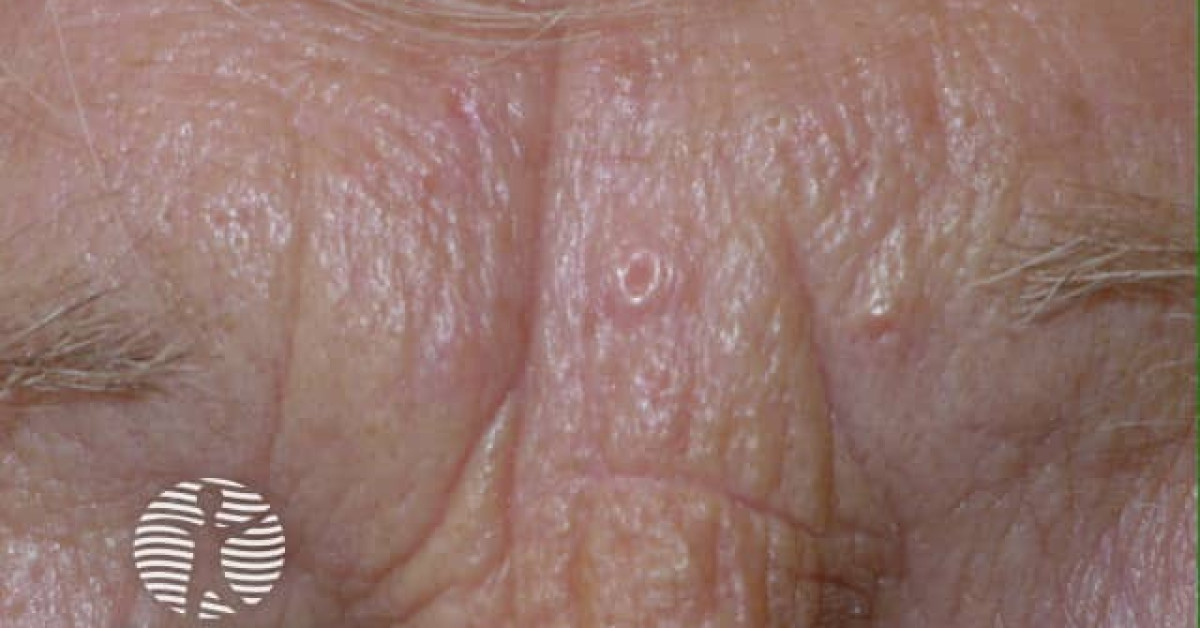 Sebaceous hyperplasia image