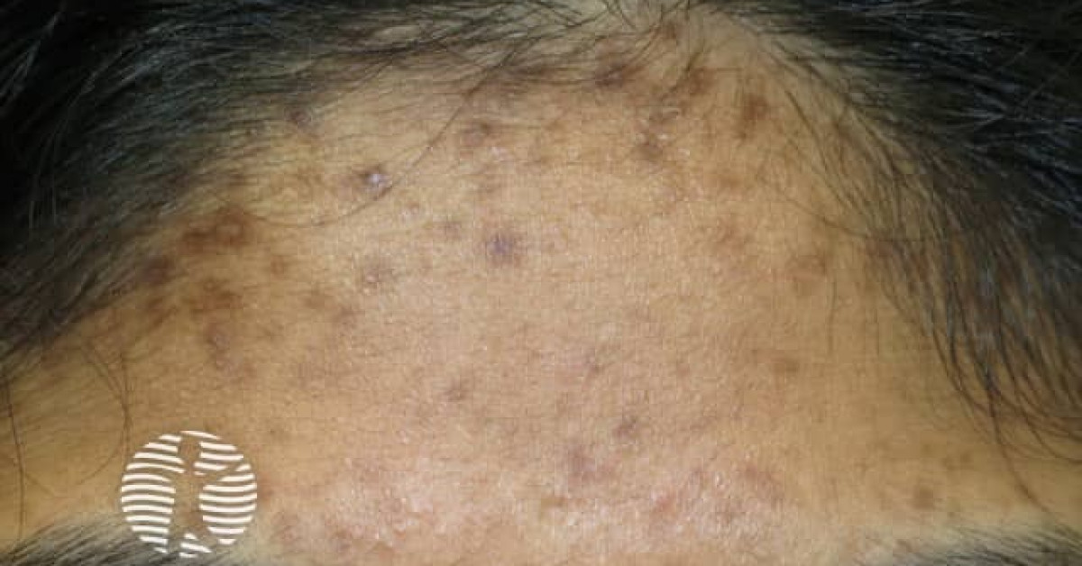 Post-inflammatory pigmentation image