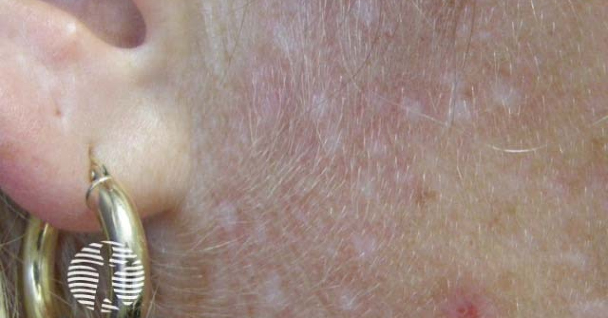 Guttate hypomelanosis image