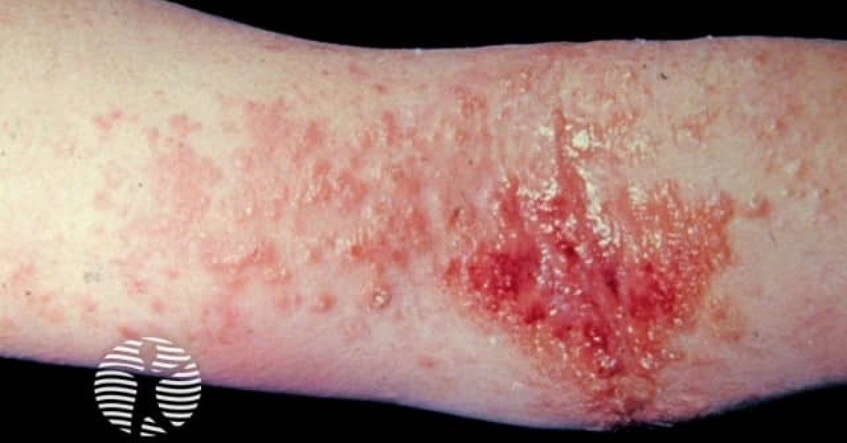 figure 9 blistering image