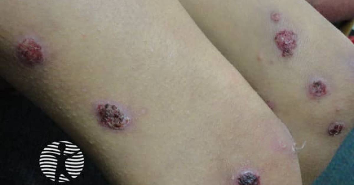 figure 9 fever+rash2 image