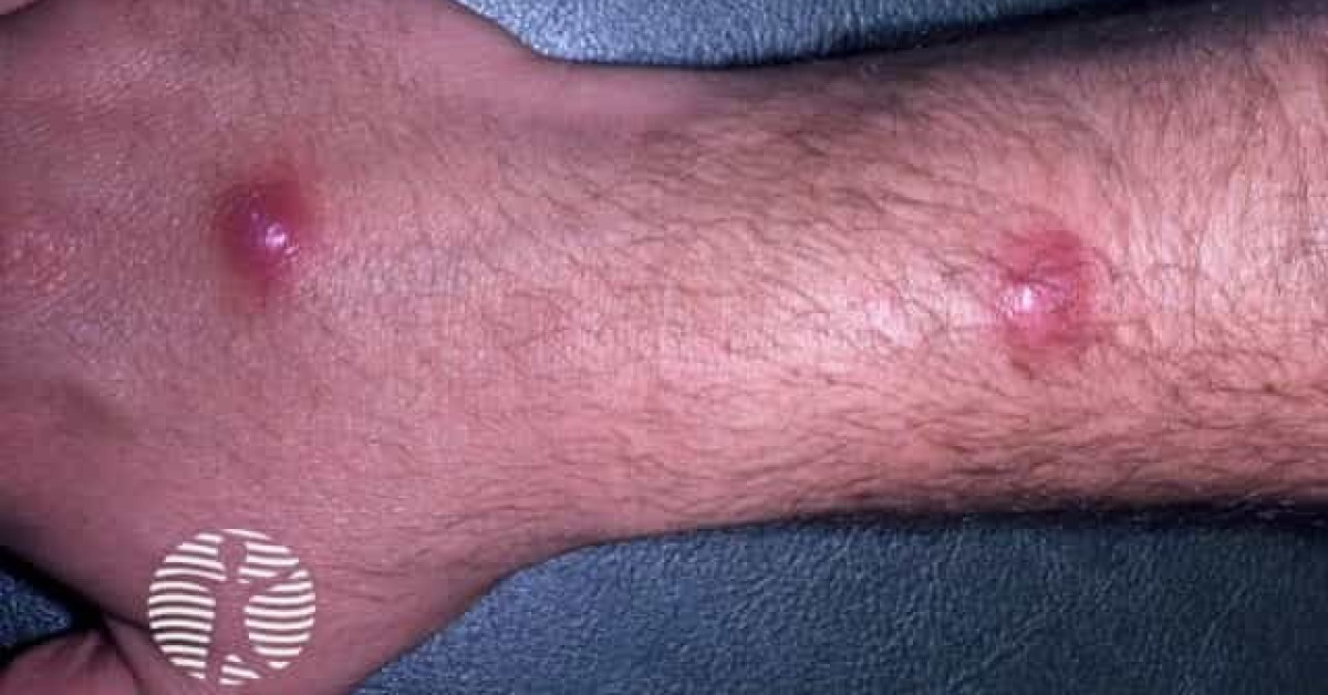 Mycobacterium marinum image