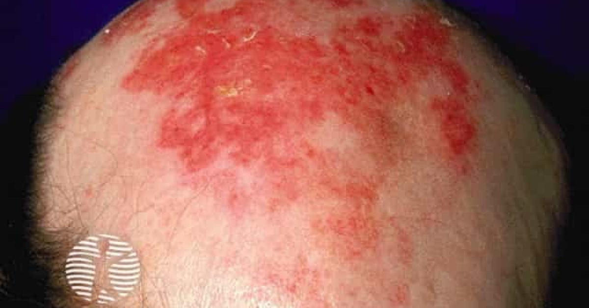 Effects Of Fluorouracil Cream Applied To Actinic Keratoses Image