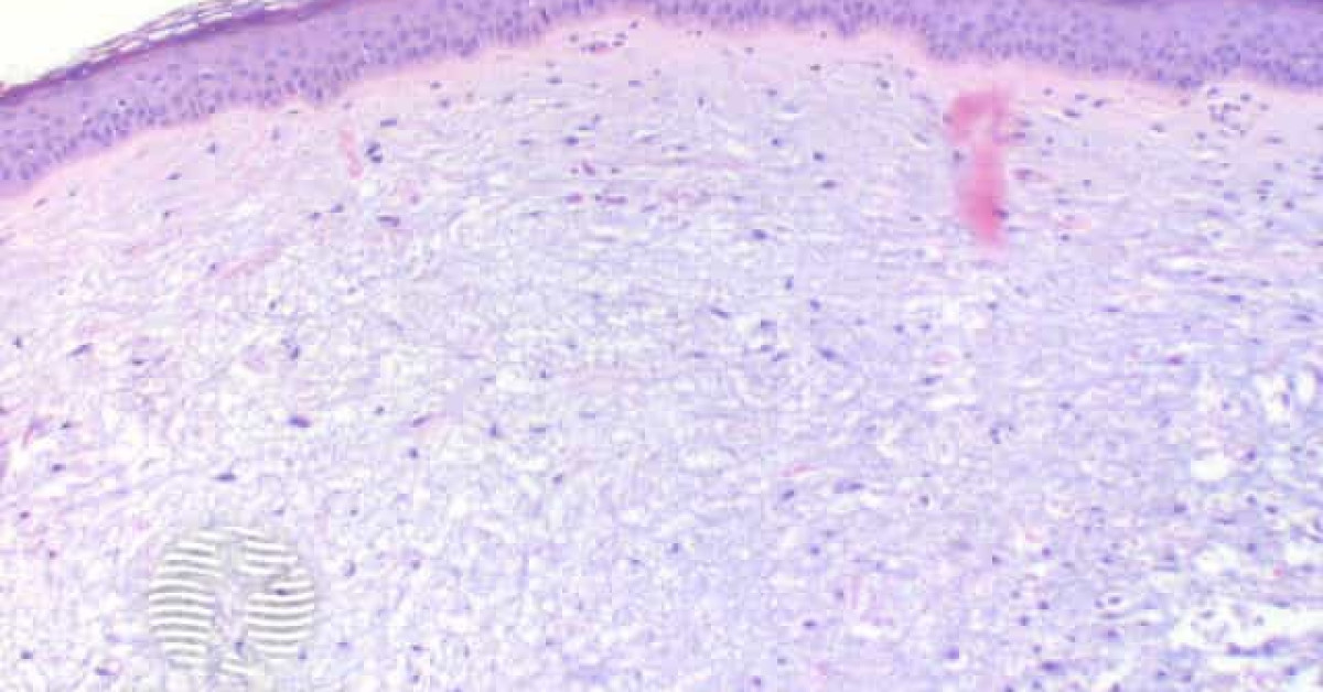 Focal mucinosis figure3 image