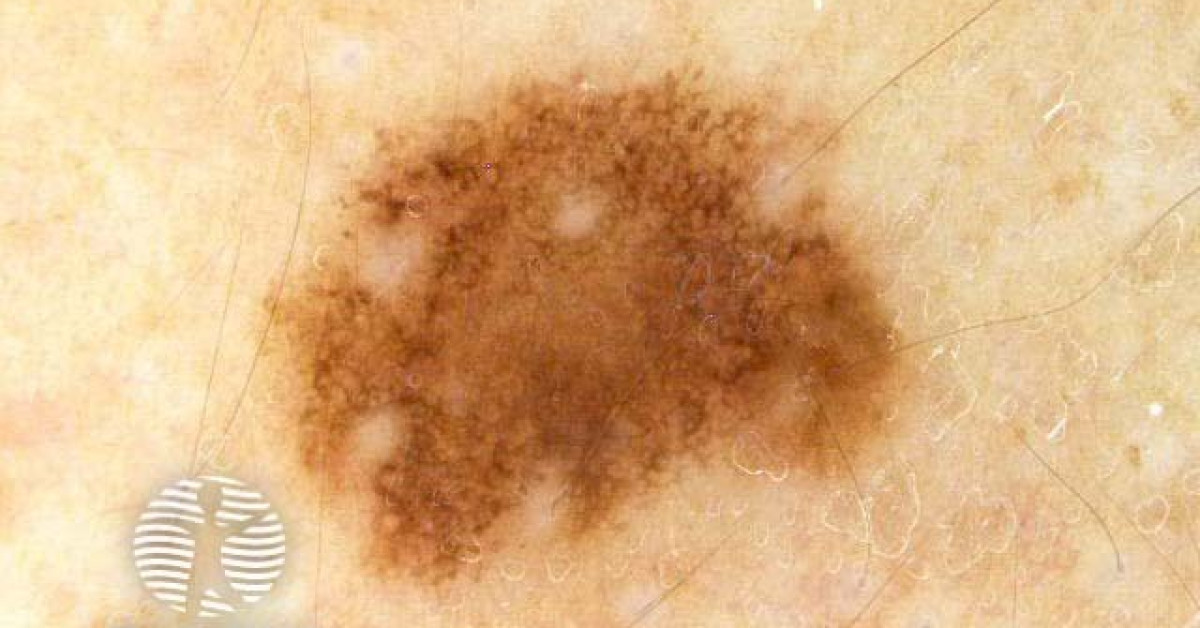 Naevus with perifollicular hypopigmentation image