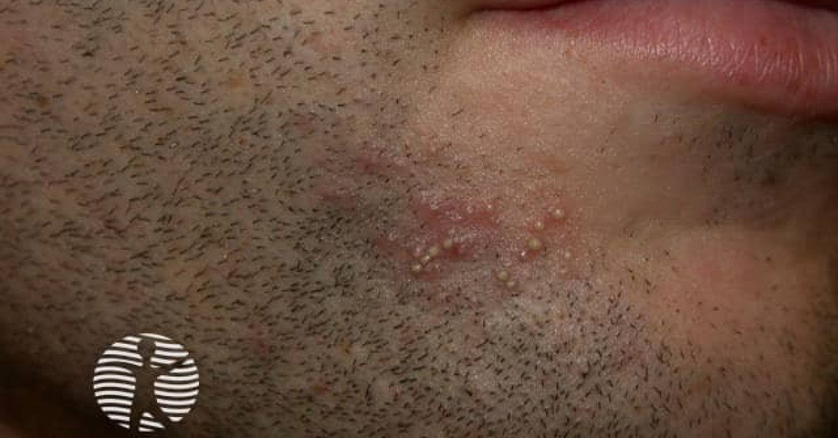 Folliculitis barbae image