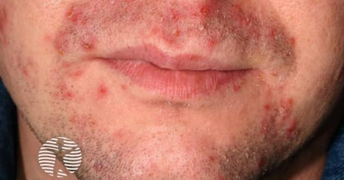Folliculitis barbae image