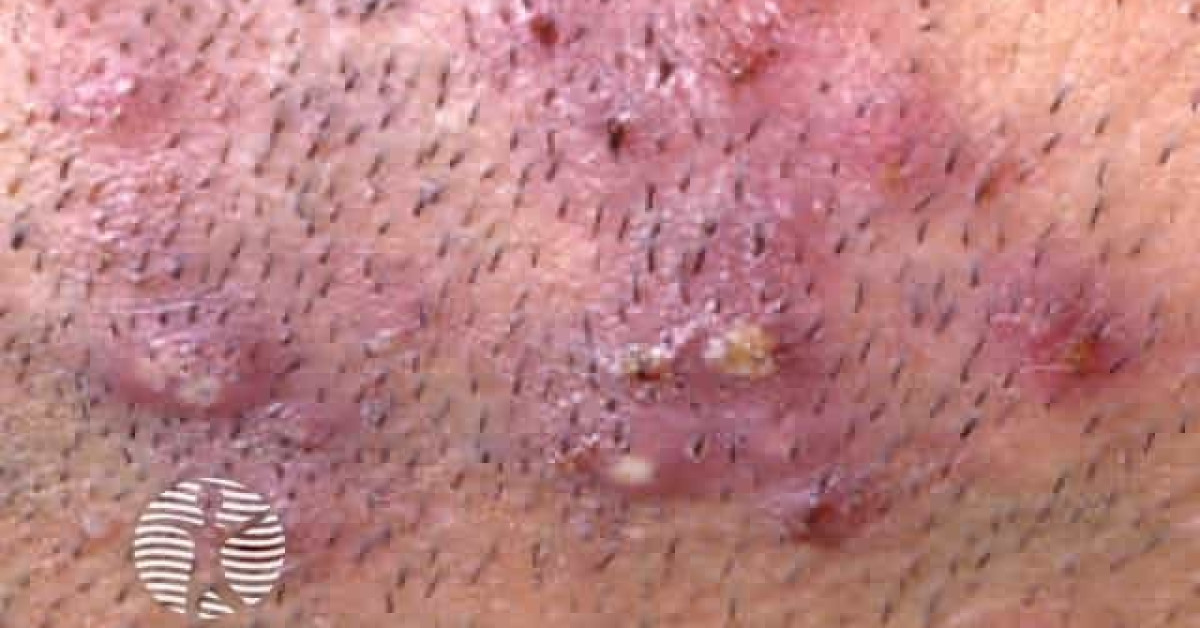 Folliculitis barbae image