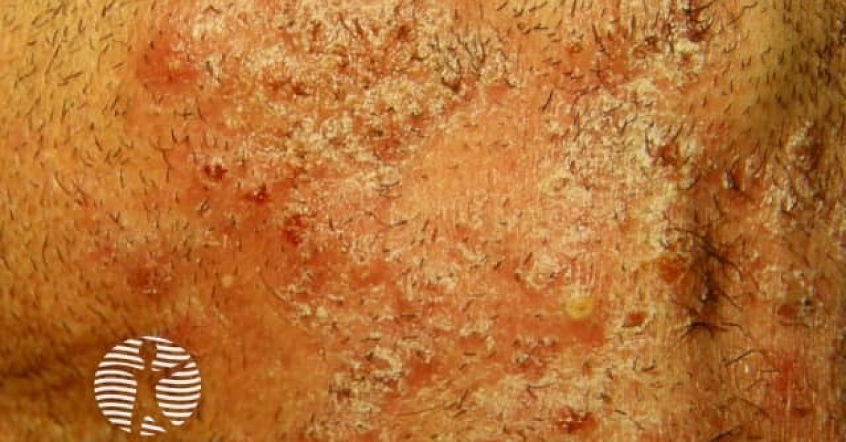 Folliculitis barbae image