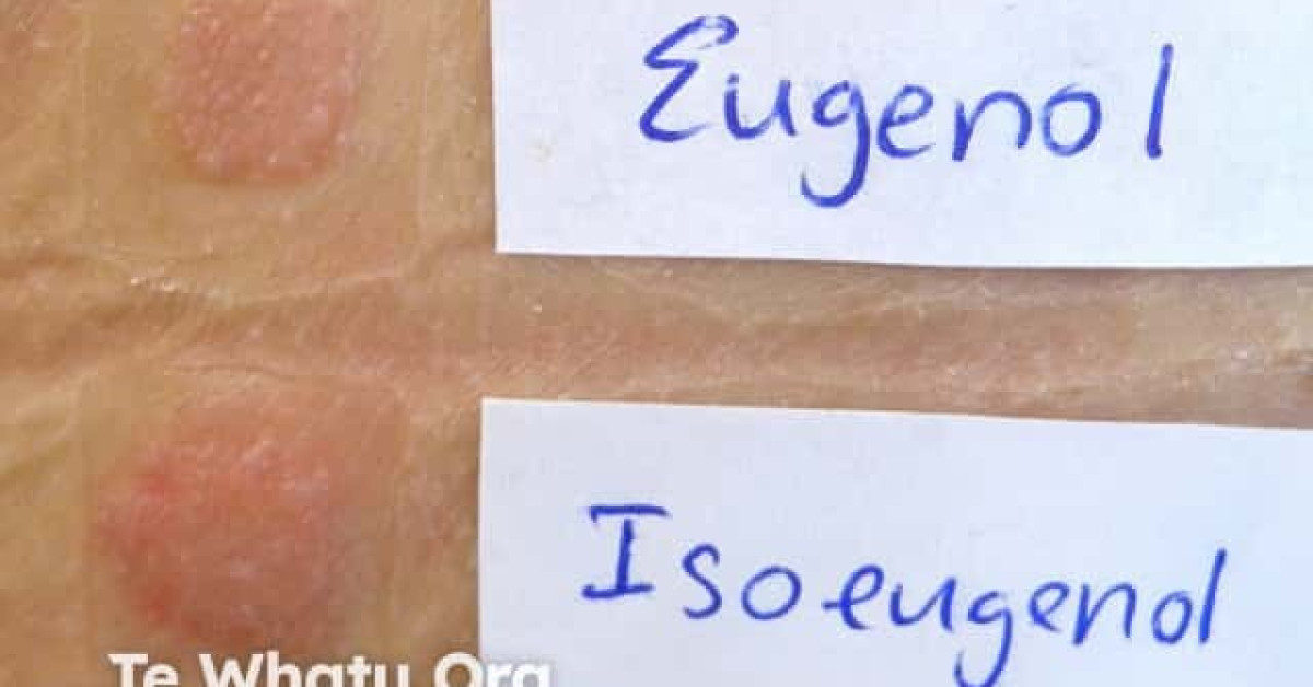 Positive patch test to eugenol/isoeugenol image