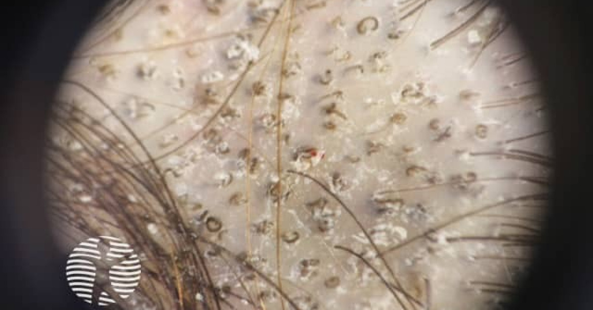 Tinea capitis dermoscopy image