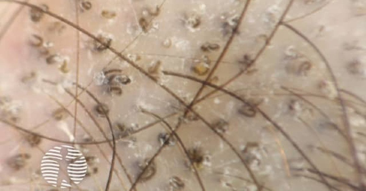 Tinea capitis dermoscopy image