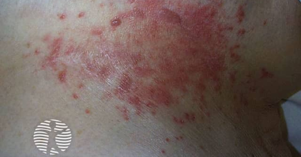 Candida intertrigo image