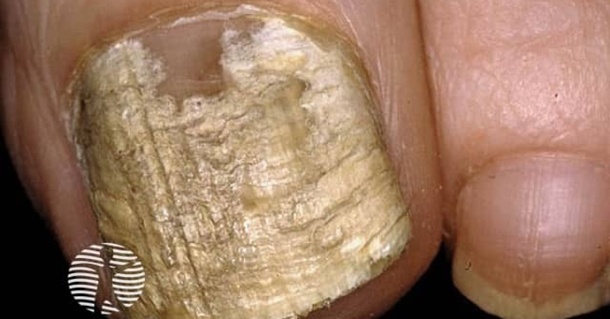 Candida albicans affecting the nail image