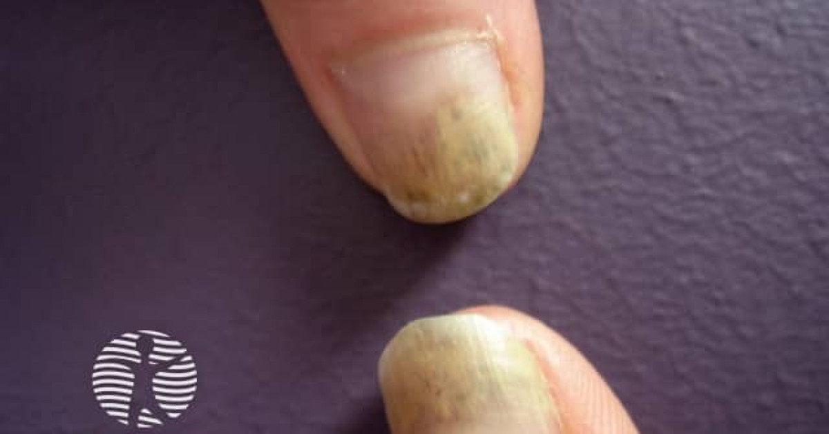 Candida albicans affecting the nails image