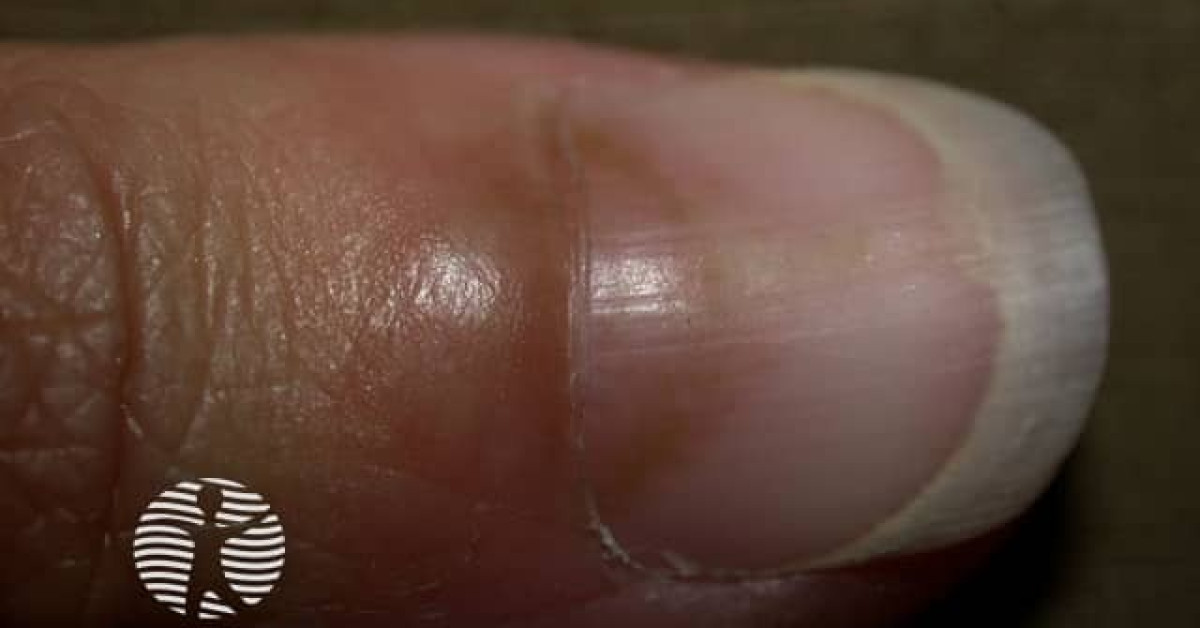 Candida albicans affecting the nails image