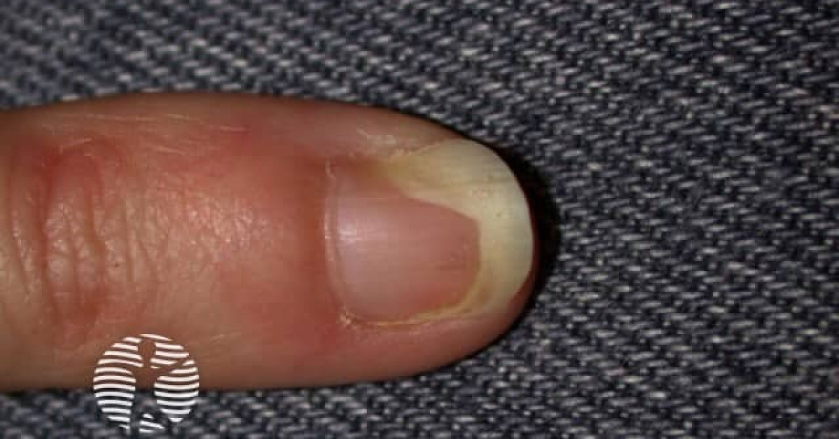 Candida albicans affecting the nails image